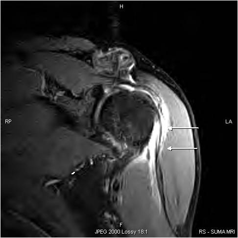 Long head of Biceps Rupture-MRI - Sumer's Radiology Blog