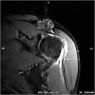 Long head of Biceps Rupture-MRI - Sumer's Radiology Blog
