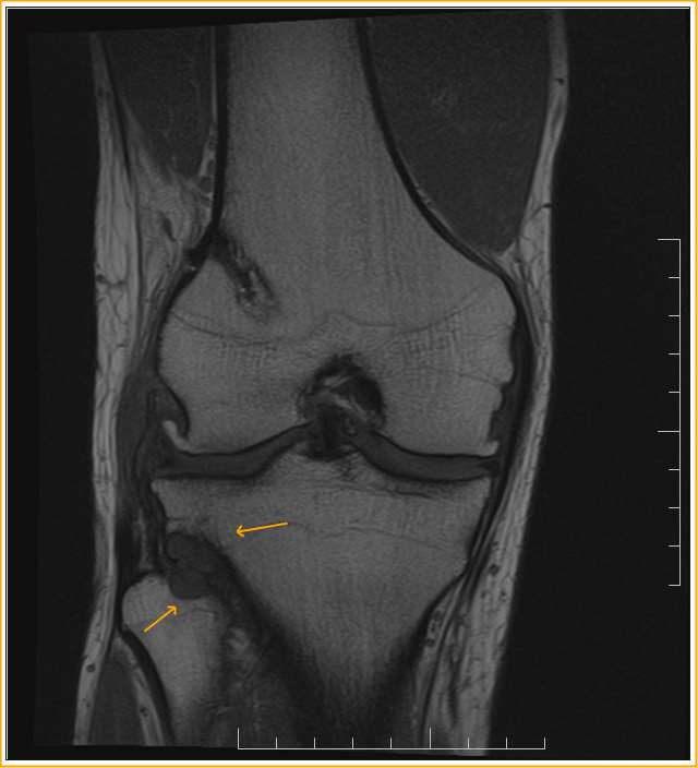 Lateral Knee Pain: Proximal Tibiofibular Joint Degenerative Arthritis ...