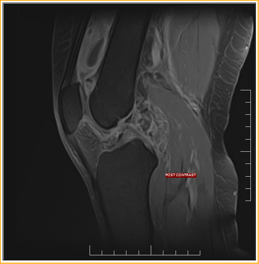 Pigmented villonodular synovitis : MRI - Sumer's Radiology Blog