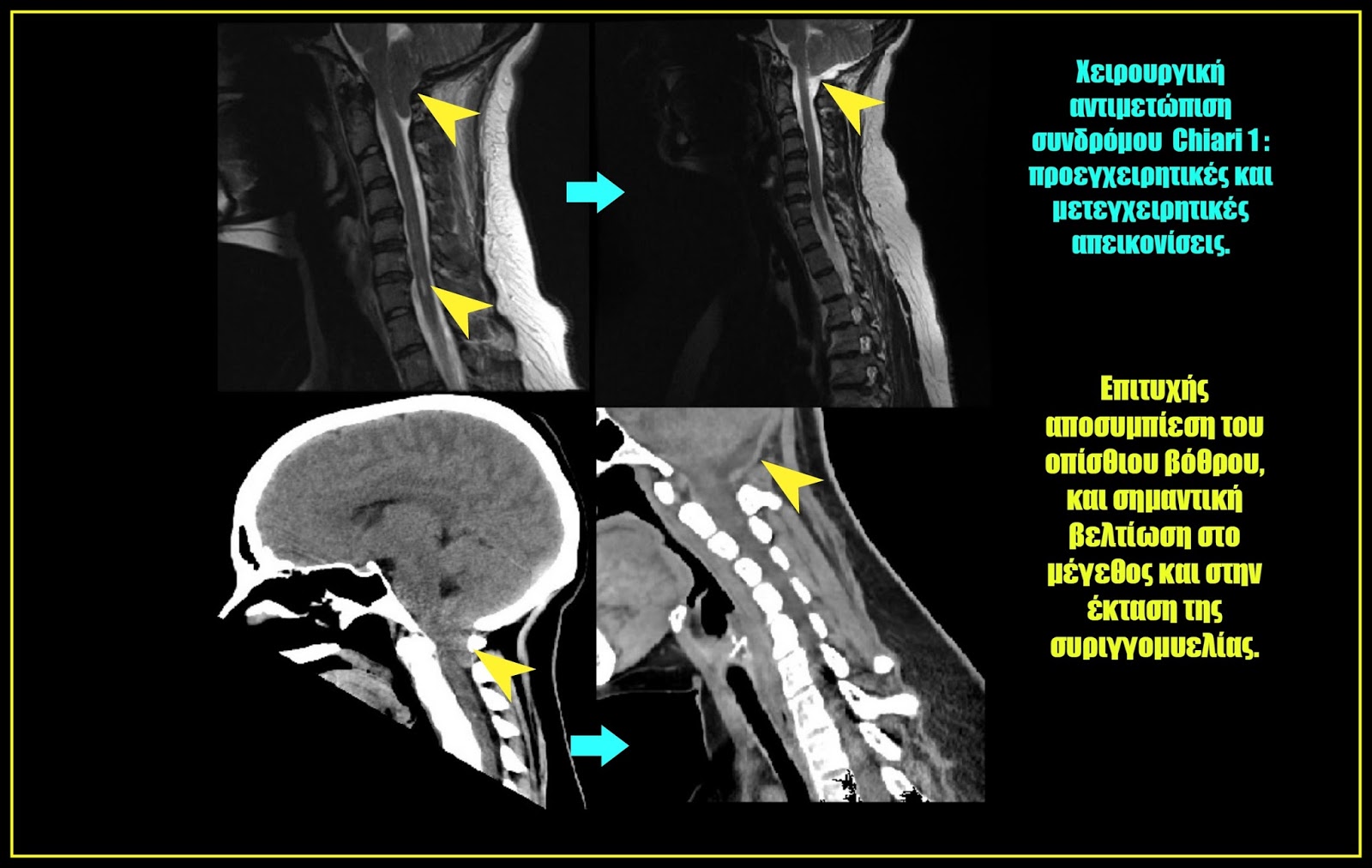 Κωνσταντίνος Χ. Δαβανέλος: Δυσπλασία Chiari με συριγγομυελία.