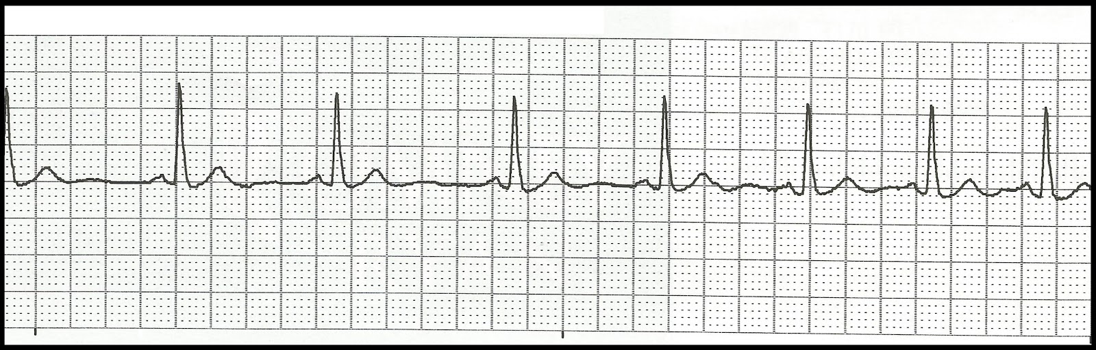 ECG Rhythm Strip Quiz 118