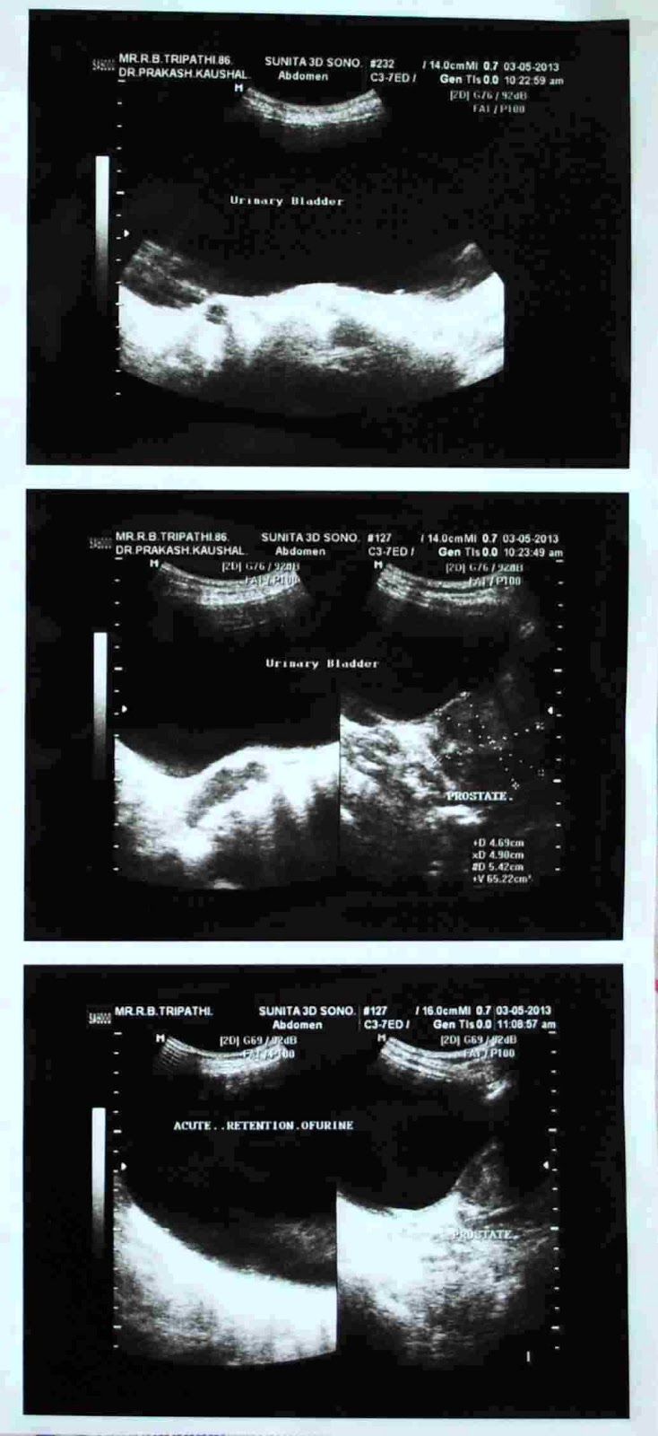 Science Doing: Urinary Bladder capacity, Acute and Chronic Urinary ...