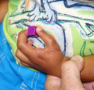 Even More Thoughts on Pollicization | Congenital Hand and Arm ...