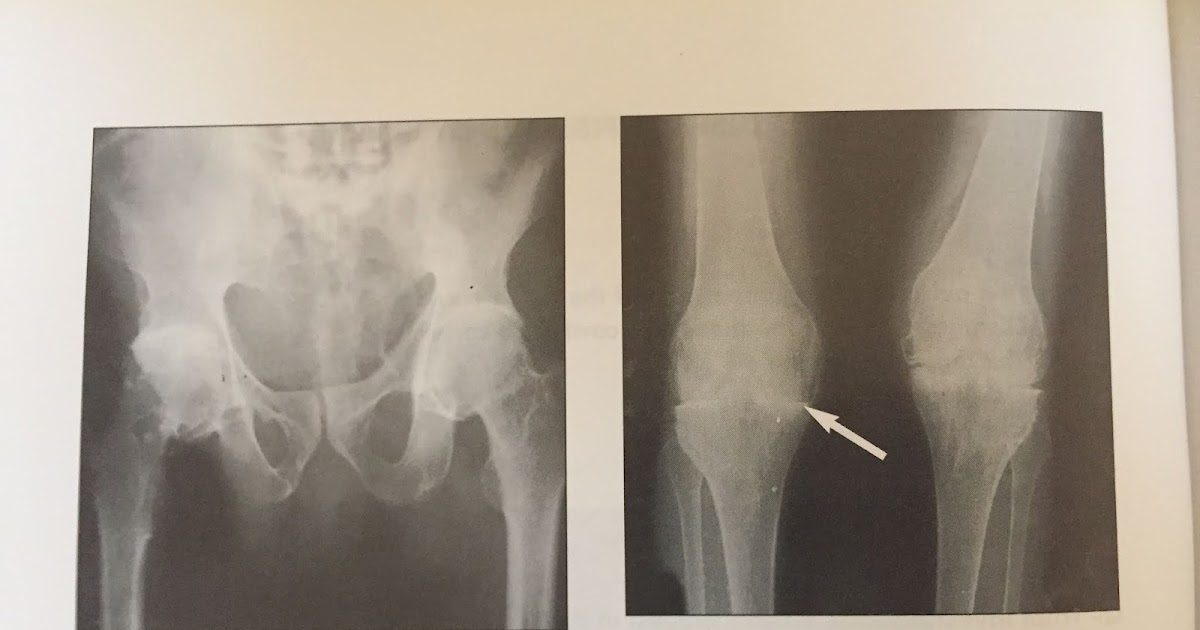 XRAYS OF RHEUMATOID ARTHRITIS