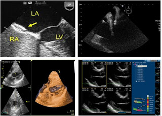 Curso de Ecocardiografía Doppler Cardíaco - El blog de Tecnoimagen