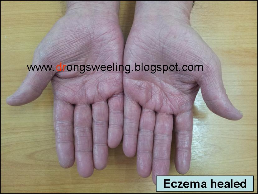 TCM News: TCM Physician Treat Eczema on Sole and Palm Dry and Cracked
