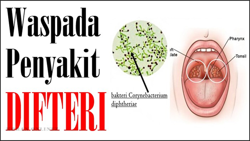 Apa itu Difteri dan Bagaimana Cara Pencegahannya? - Situs Berita ...