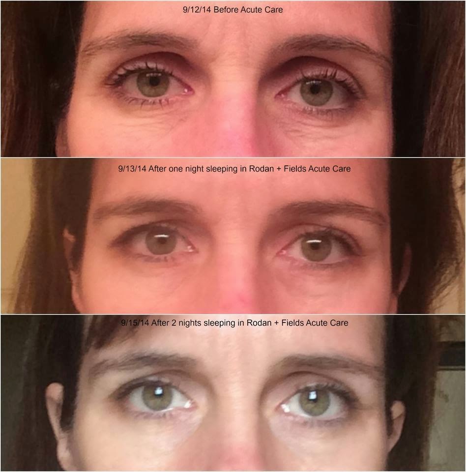 Skincare, Beauty, Fashion and Fitness: Acute Care for Expression Lines!!