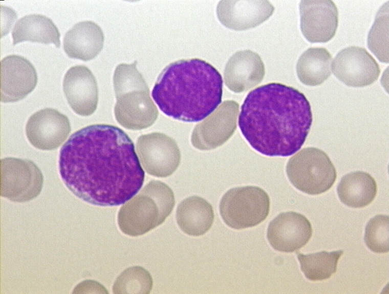 HEALTH FROM TRUSTED SOURCES: Acute Lymphoblastic Leukemia