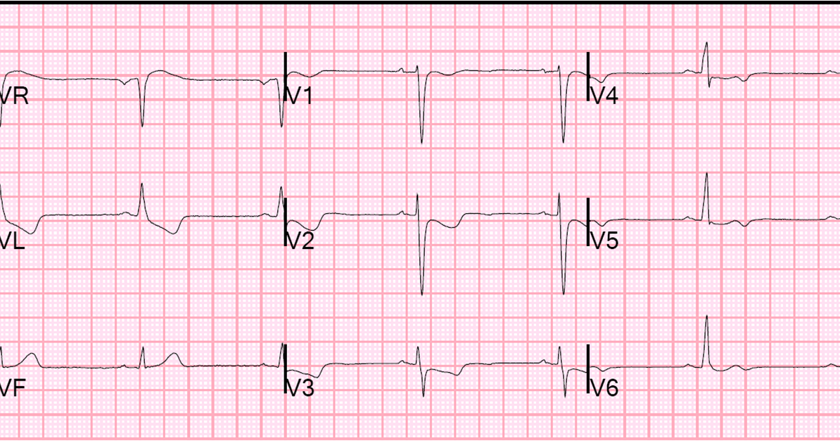 What Does A Normal Ecg Look Like : A normal ekg is one that shows what ...