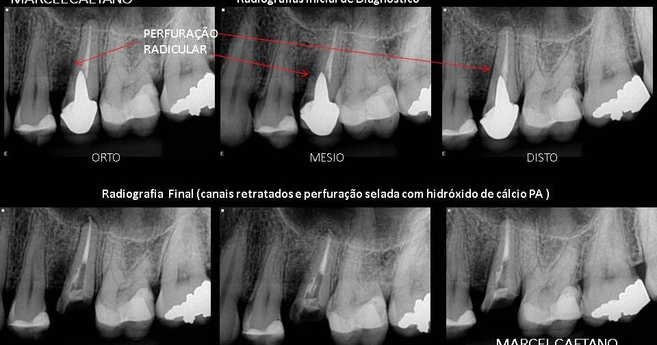 Endodontia Avançada: Utilização do Microscópio Operatório Dental para ...