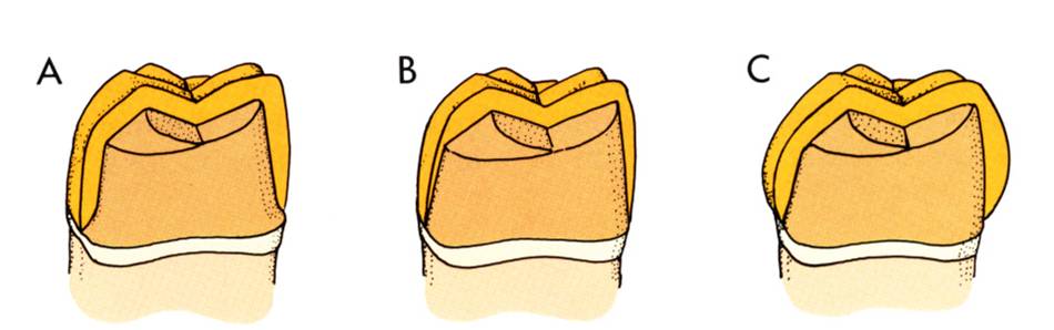 FUNCTIONAL CUSP BEVEL ~ Welcome To Dental lecture Class