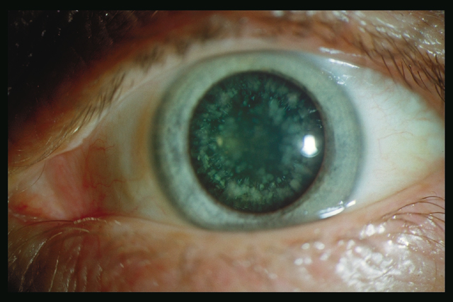 Deformutilation: Cataracts