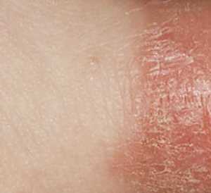 7 Penyebab Gatal Pada Kulit, beserta Tanda-Tandanya