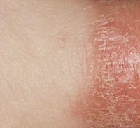 7 causes de démangeaisons cutanées, ainsi que les signes – Comment ...