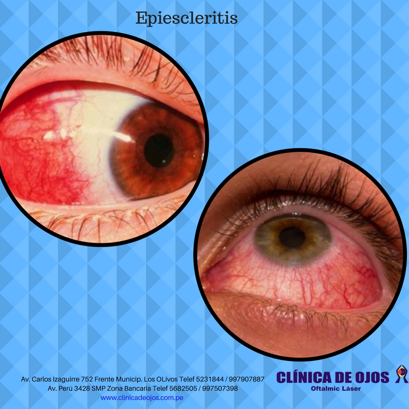 Clínica de Ojos Oftalmic Láser: Epiescleritis
