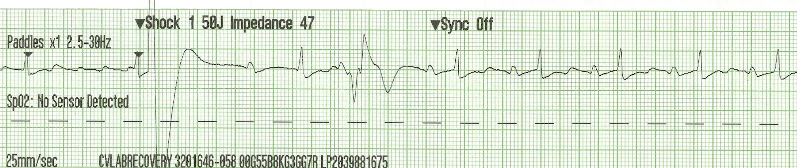 EKG Rhythm Strips 87: Cardioversion of Atrial Flutter