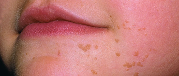 Photos of Warts on Face ~ How To Remove Moles, Warts, Skin Tags Safely