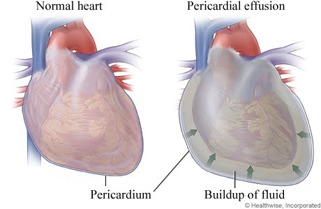 Sliced and Sutured: Thoracoscopic Pericardial Window