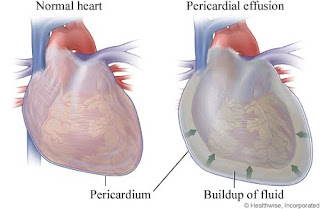 Sliced and Sutured: Thoracoscopic Pericardial Window
