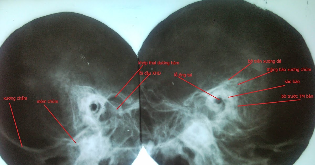 Tư thế, tiêu chuẩn , cách đọc phim X quang Tai Mũi Họng | Bác Sĩ Đa Khoa