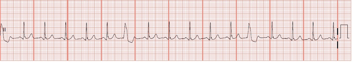 EKG Rhythm Strip Quiz 57: Ectopic Beats