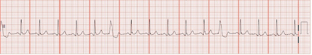 EKG Rhythm Strip Quiz 57: Ectopic Beats