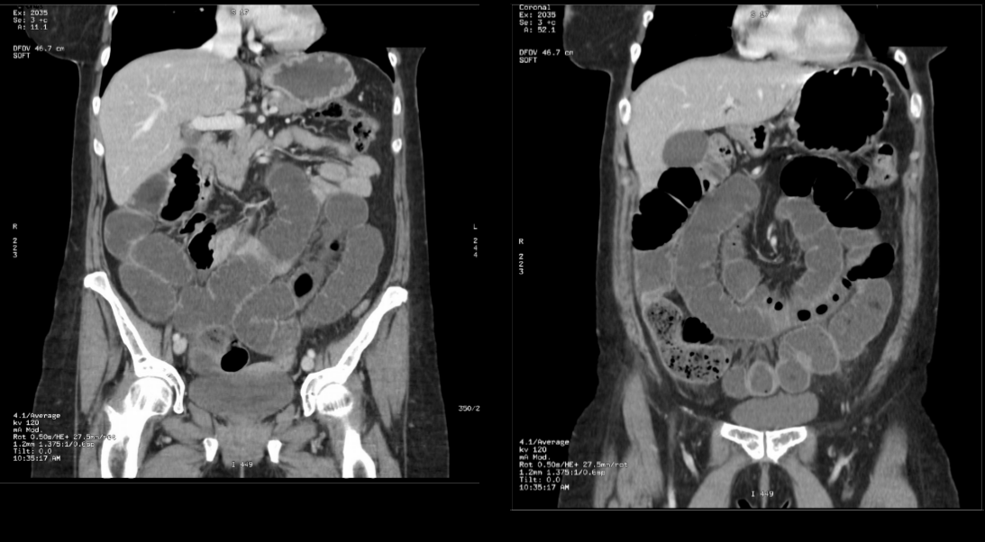 El Blog de Isa y Juan: Obstrucción intestinal por bridas