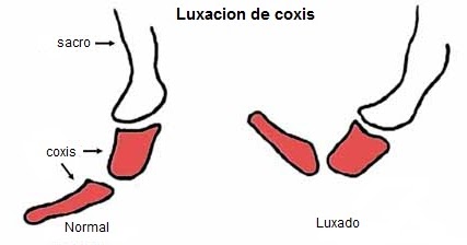 Doctor me duele mucho!!! Luxación de coxis