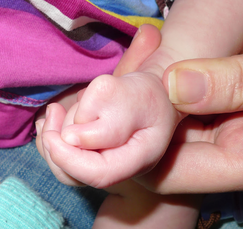 Difficult Extra Thumbs | Congenital Hand and Arm Differences ...