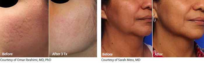 Dr Gerard Ee | Clifford: Infini Microneedle Fractional Radiofrequency ...