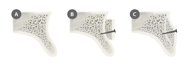 Medical illustration of block graft and GBR techniques for baseline