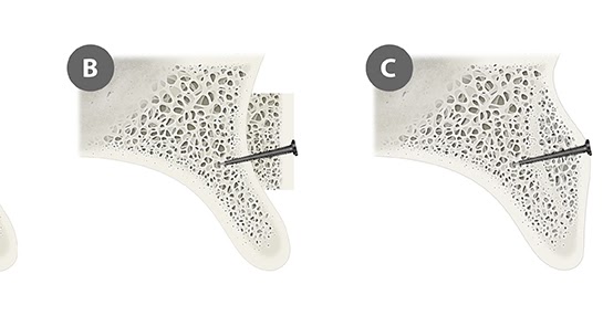 Medical illustration of block graft and GBR techniques for baseline