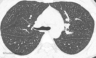 RiT radiology: Miliary Tuberculosis