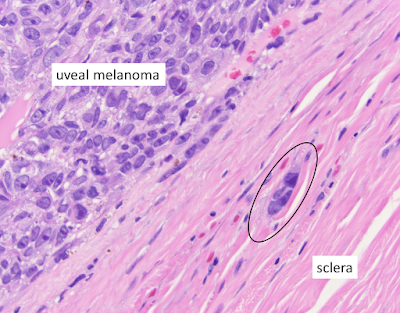 neuropathology blog: Scleral invasion by uveal melanoma