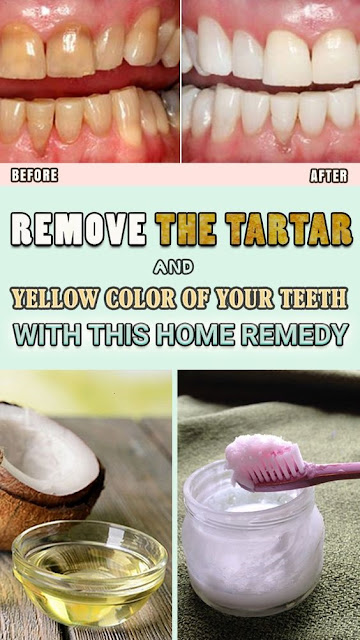 REMOVE THE TARTAR AND YELLOW COLOR OF YOUR TEETH WITH THIS HOME REMEDY ...