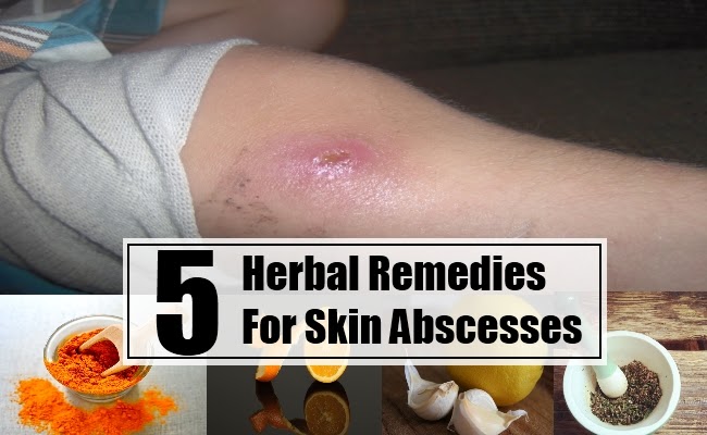 5 HERBAL REMEDIES FOR SKIN ABSCESSES ~ Mzizi Mkavu