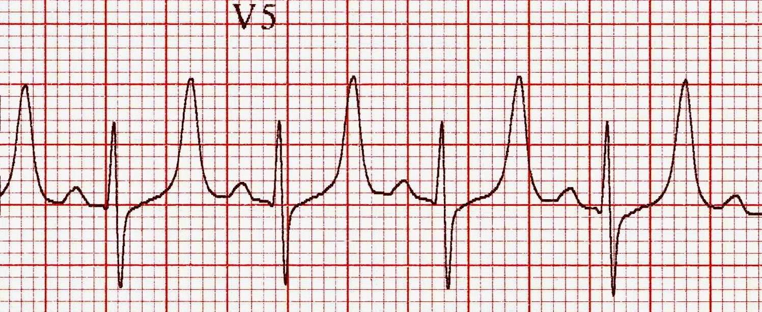 Enciclopédia de ECG - Nomenclatura: Onda T