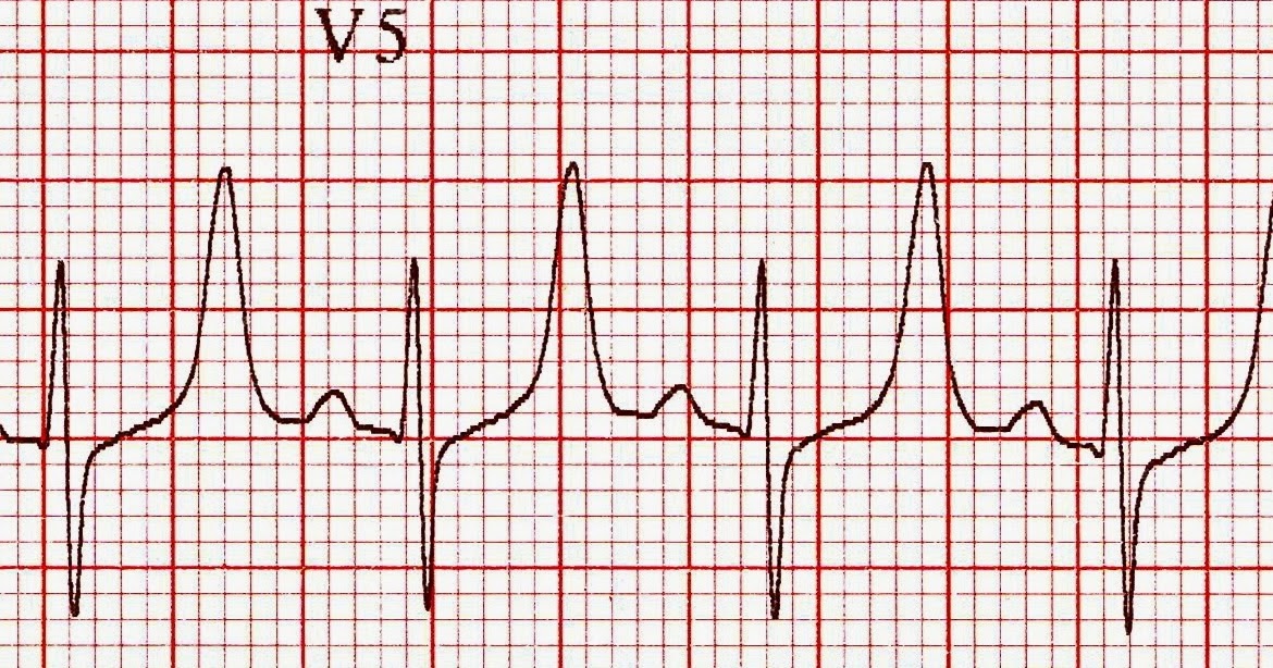 Onda T Apiculada Ecg - RETOEDU