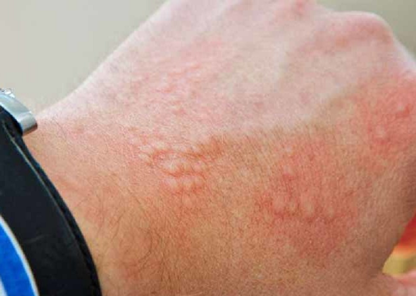 Mengatasi Penyakit Rhinitis: Mengatasi Alergi Dingin secara Alami