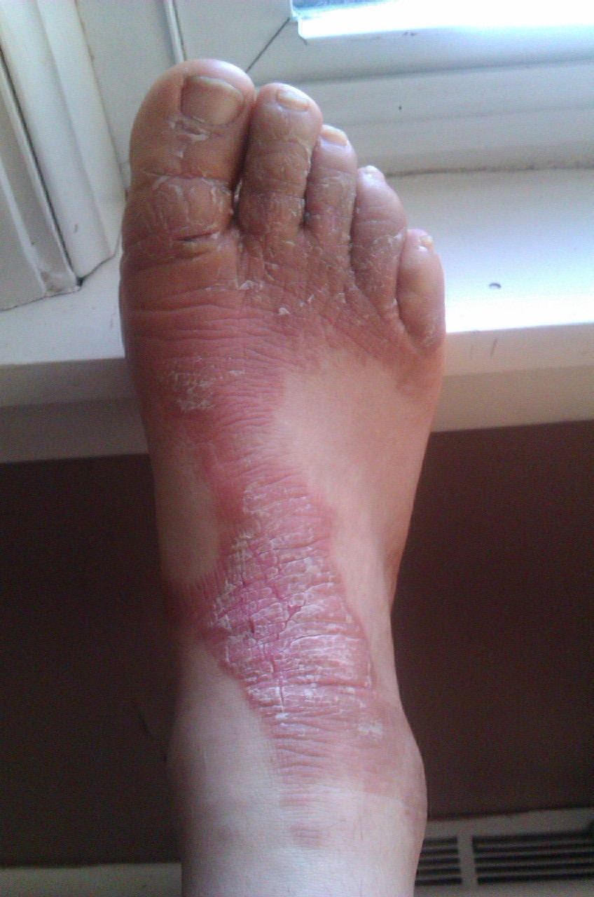 GAPS for Psoriasis: Psoriasis