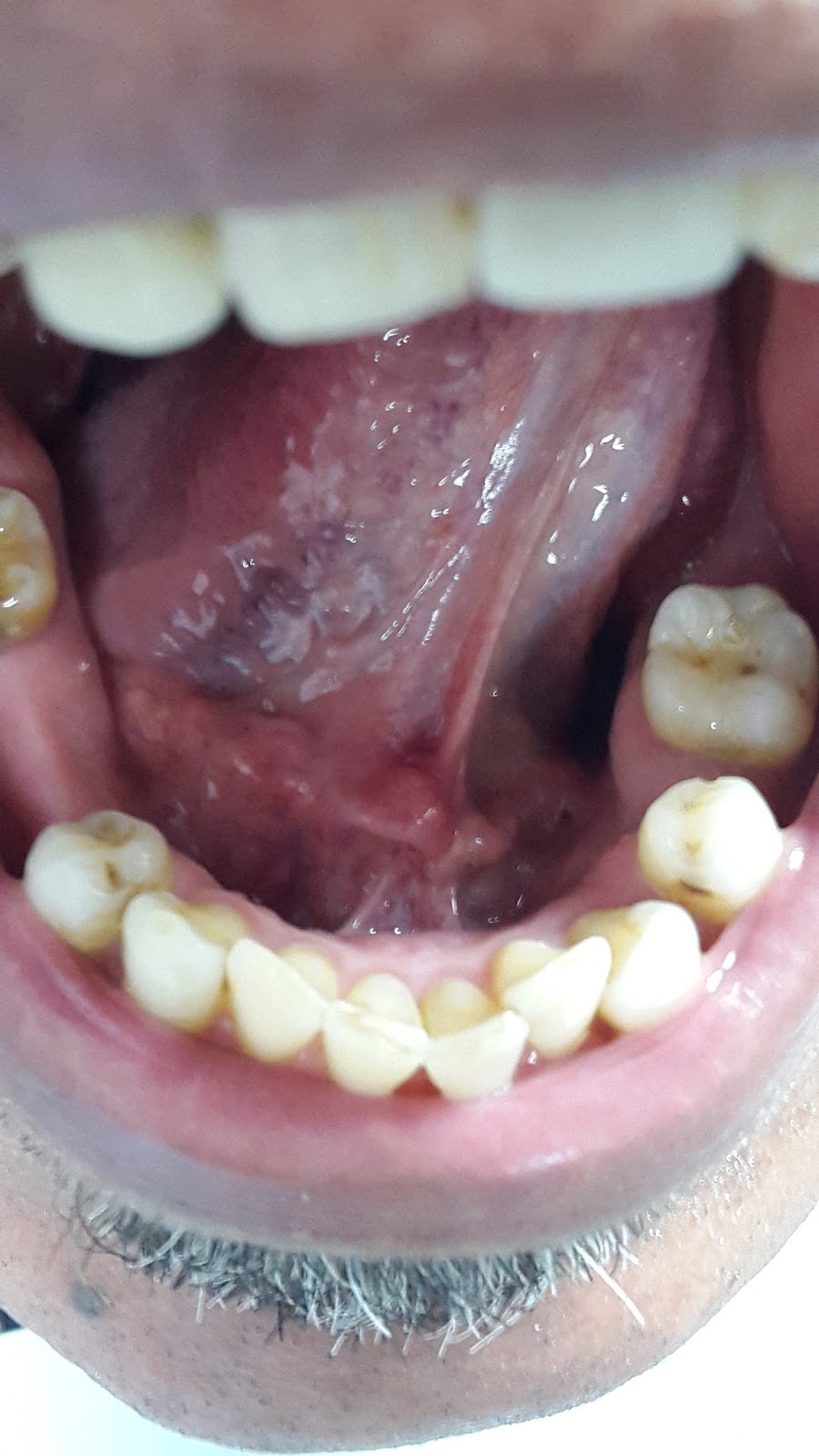 Sialolito (sialolitíase ou "pedra" de glândula salivar) - CIRURGIA ...