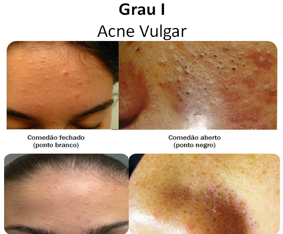 Dicas de farmacêutico: Modulo I Série Acne