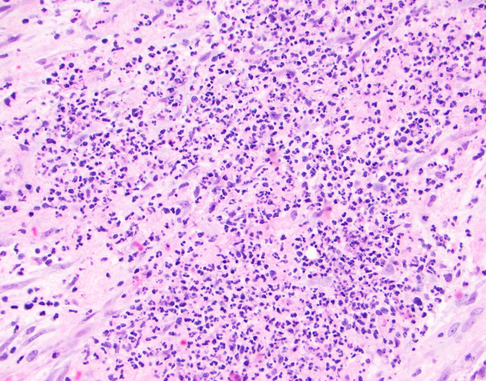 neuropathology blog: Nocardia farcinica brain abscess