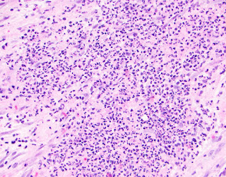 neuropathology blog: Nocardia farcinica brain abscess