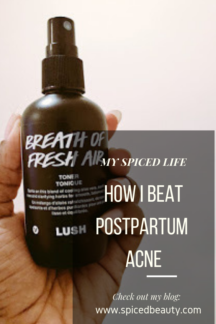 Postpartum acne is REAL! | My Spiced Life: Beauty + Lifestyle Blog