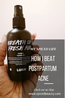 Postpartum acne is REAL! | My Spiced Life: Beauty + Lifestyle Blog