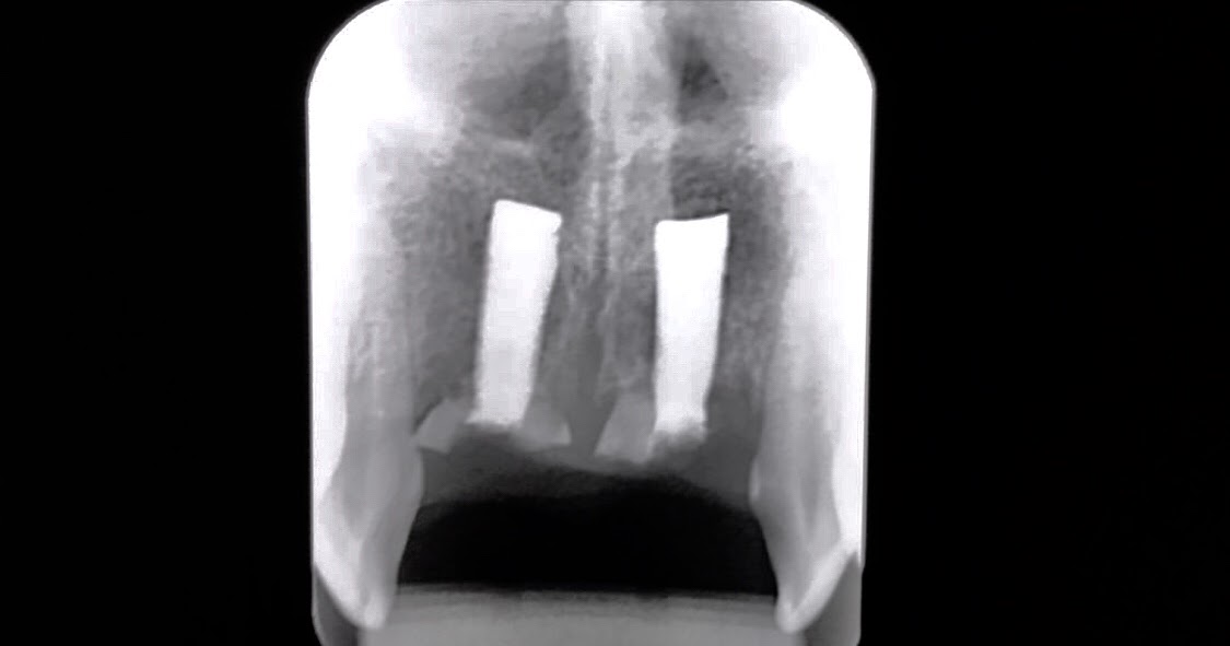 Complete root resorption after endo treatment in young permanent teeth ...