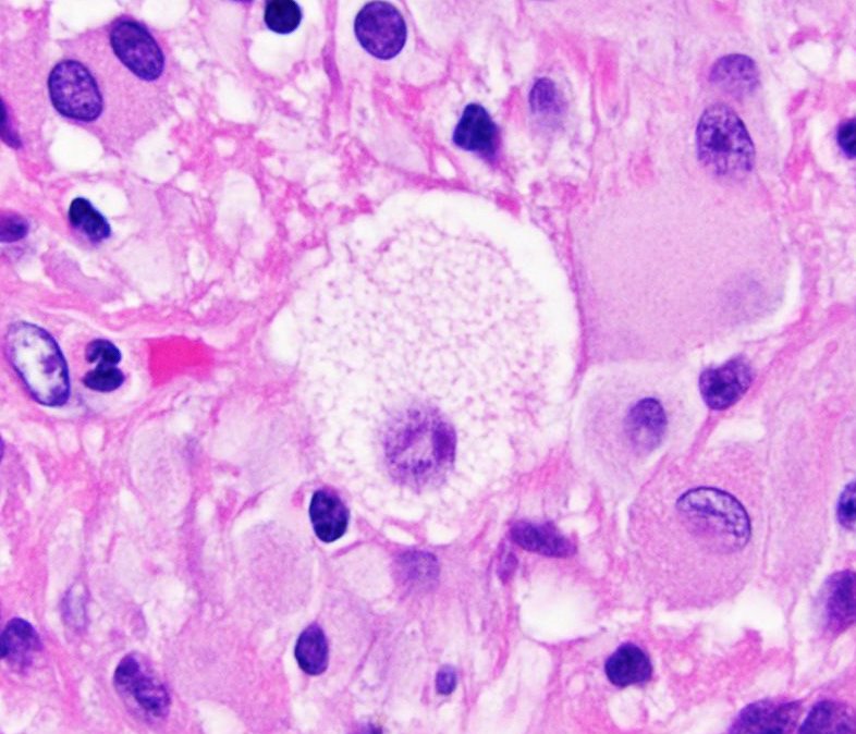 neuropathology blog: Xanthic cell in a pleomorphic xanthoastrocytoma